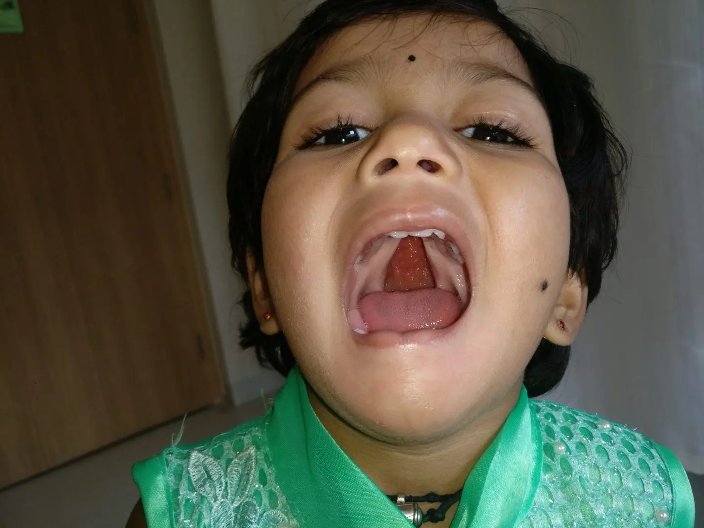 Hasenscharte: Ursachen, Diagnose & Behandlung | Hebamme FZ